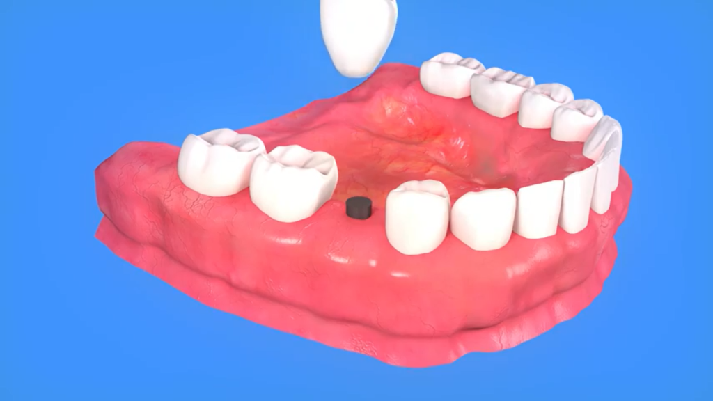 Implant Surgery - Implant Clinic