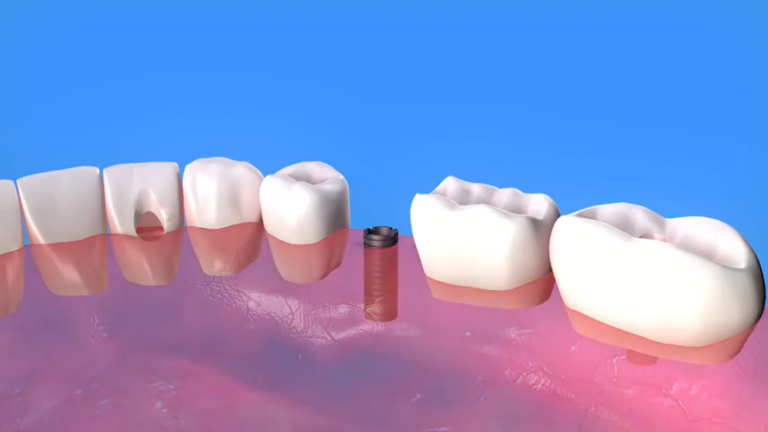 Types implants and techniques - Implant Clinic